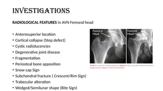 OA & AVN.pptxJGFTRDYFRGYCKTYGRDTFGFGGGGGJ | PPTX