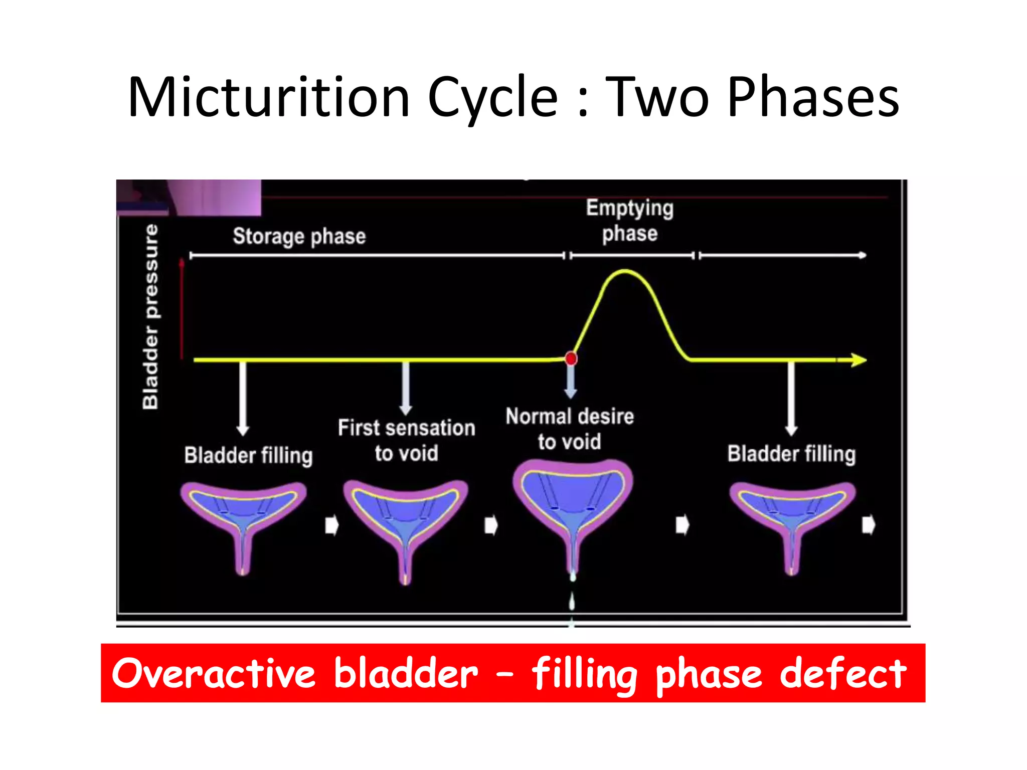 Over Active Bladder ‘an enigma’ Dr Jyoti Agarwal Dr Sharda Jain | PPTX
