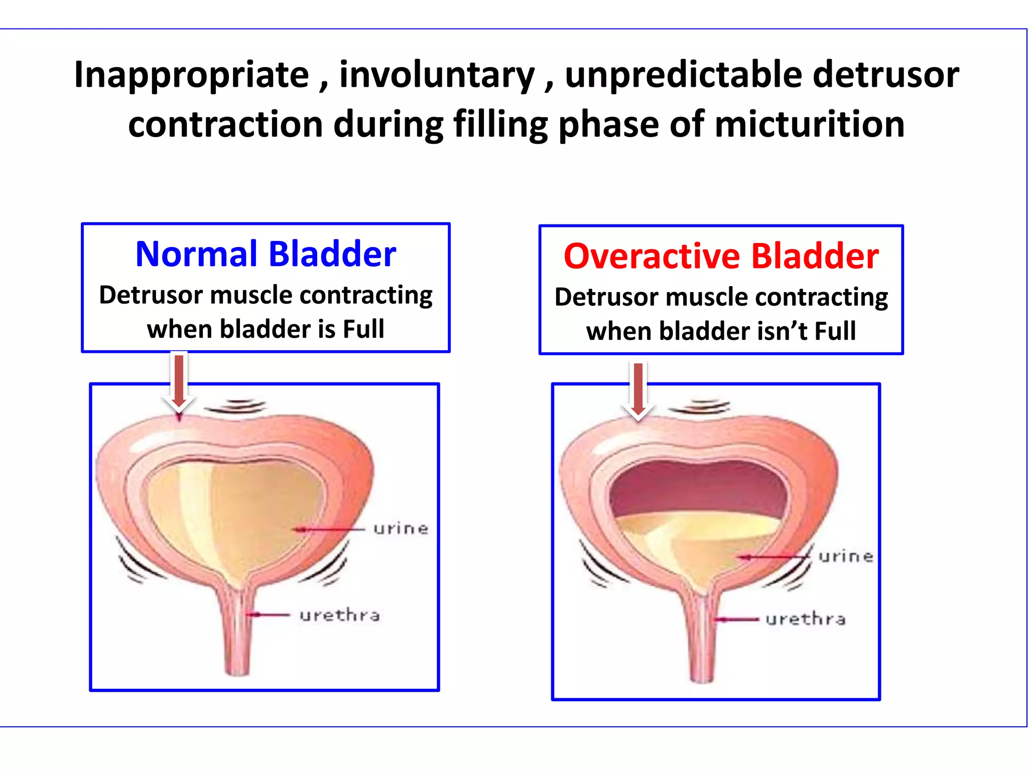 Over Active Bladder ‘an enigma’ Dr Jyoti Agarwal Dr Sharda Jain | PPT