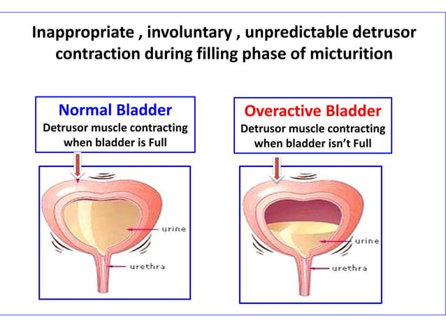 Over Active Bladder ‘an enigma’ Dr Jyoti Agarwal Dr Sharda Jain | PPTX