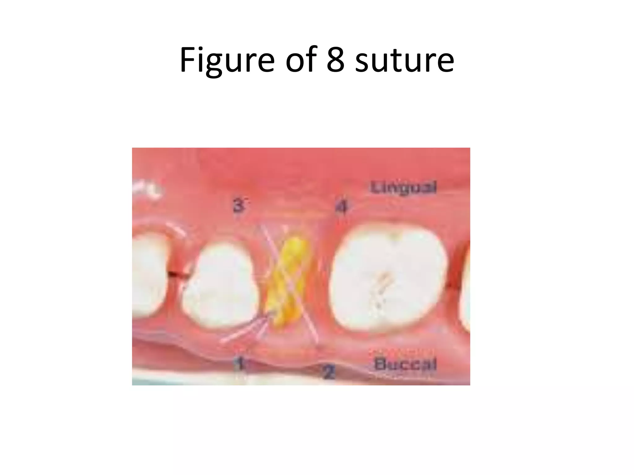 Oroantral fistula | PPTX