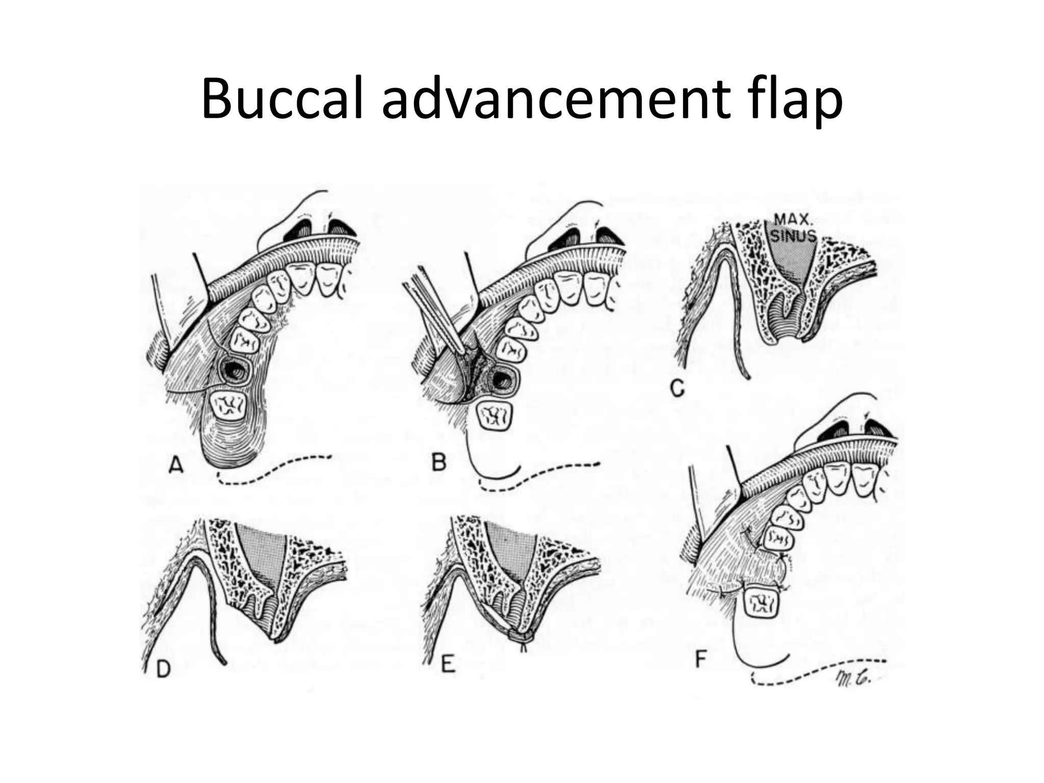Oroantral fistula | PPTX