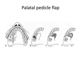 Oroantral fistula | PPTX