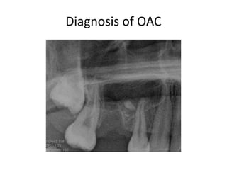 Oroantral fistula | PPTX