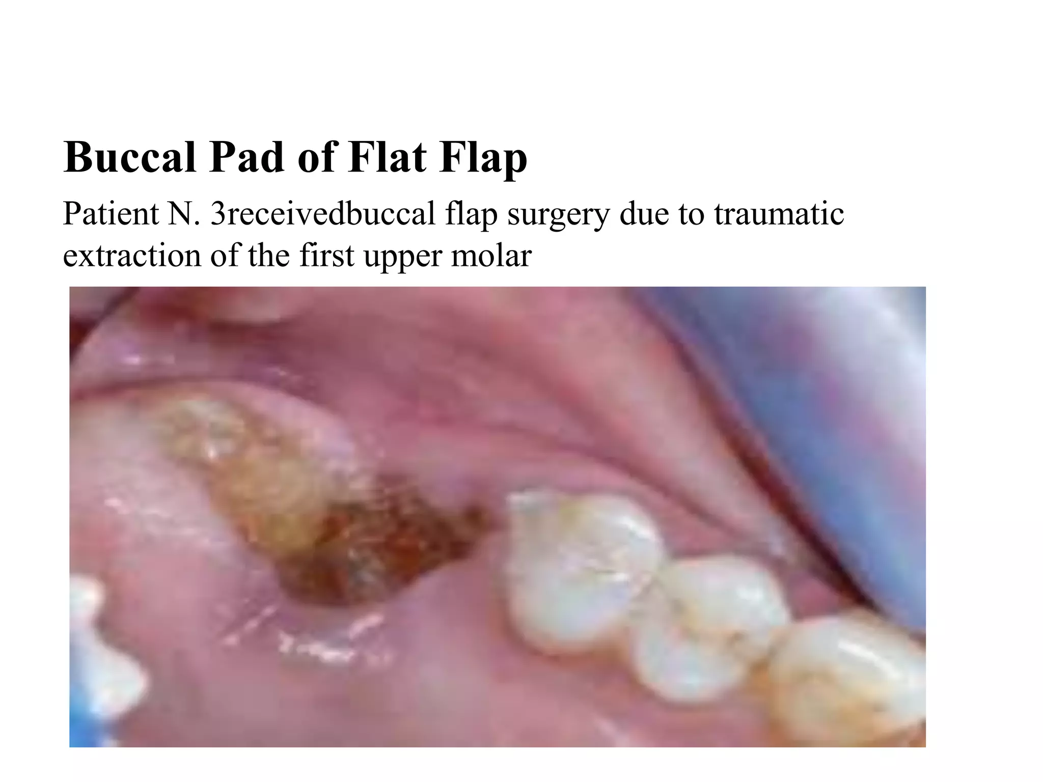 Oroantral Communication and Oroantral Fistula | PPTX