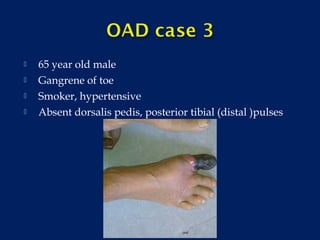 Distal Pulses