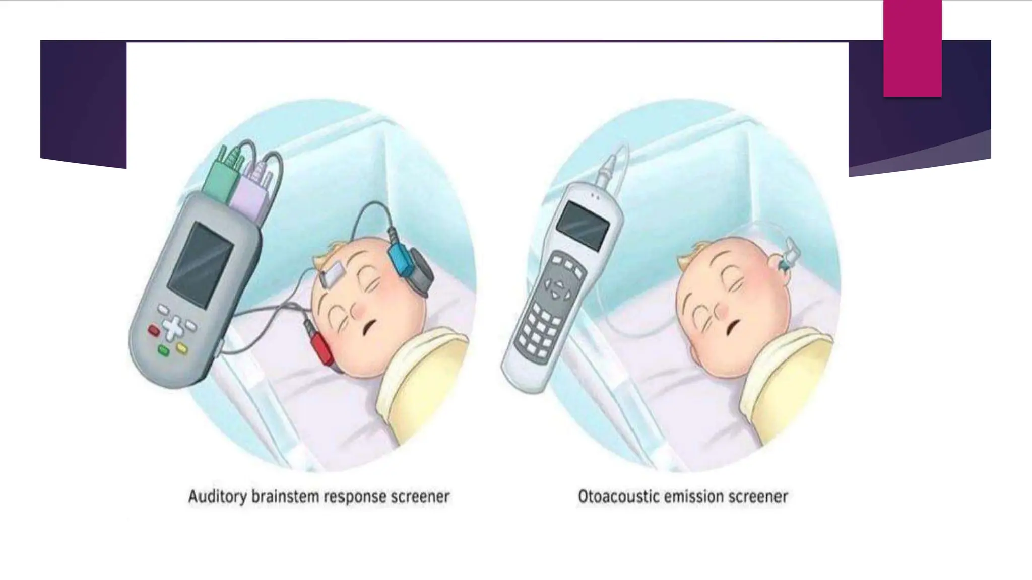 oae newborn hearing screening useful in newborn.pptx