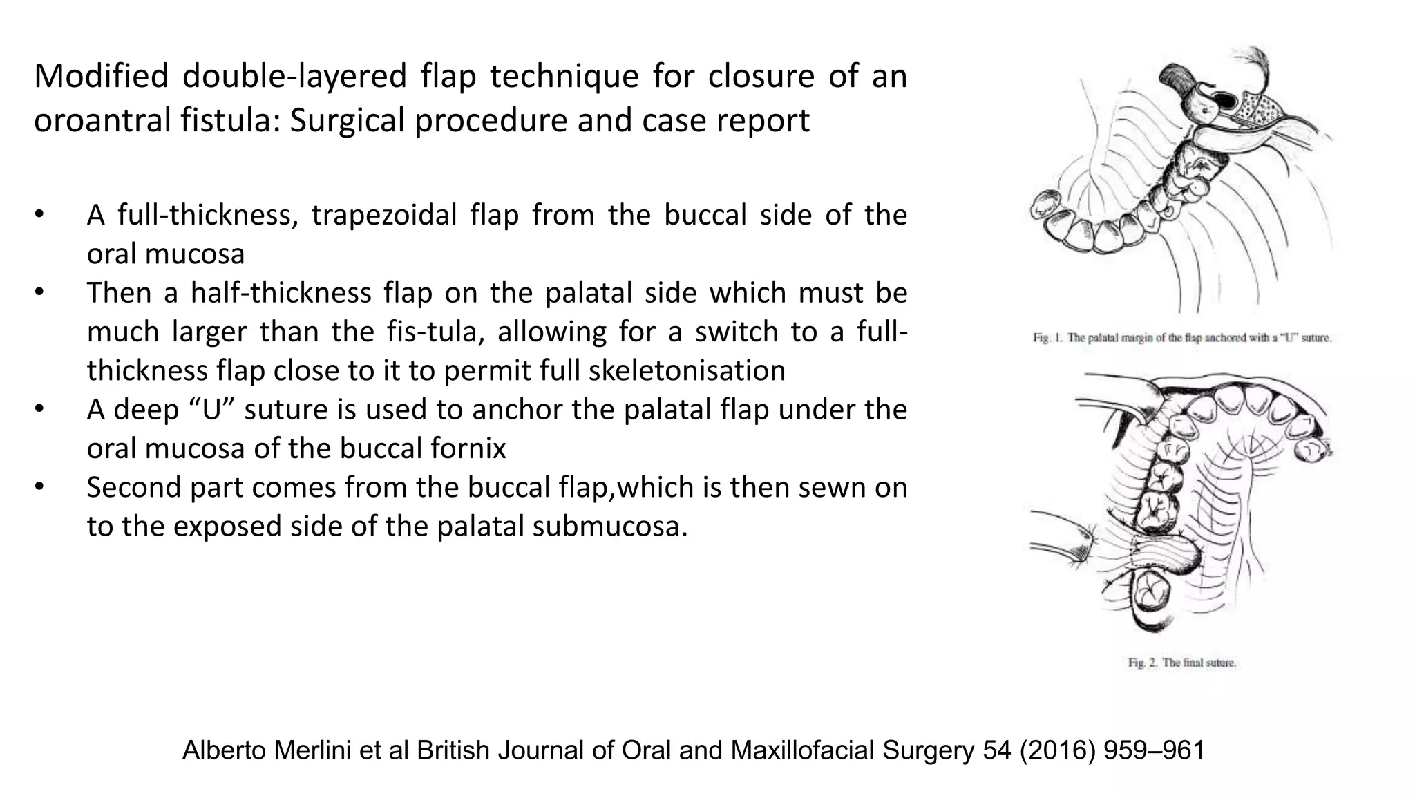 Oro-antral fistula | PPTX