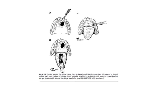 Oro-antral fistula | PPTX | Ear, Nose and Throat Conditions | Diseases ...