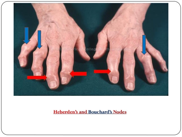 Oa for undergraduates