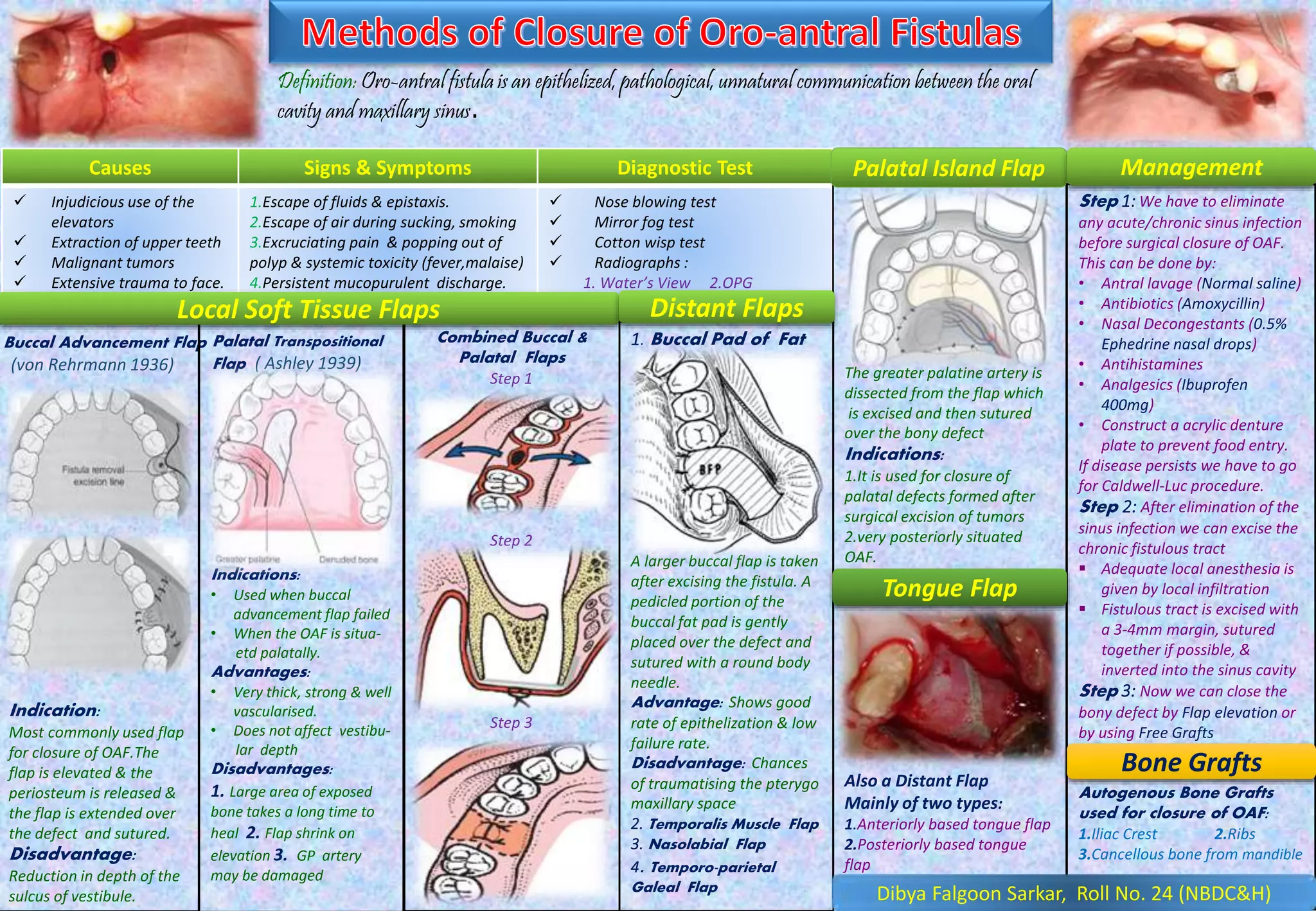 Oro-antral Fistula Poster | PPTX