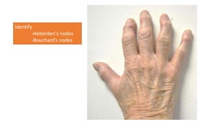 Osteoarthritis | PPTX