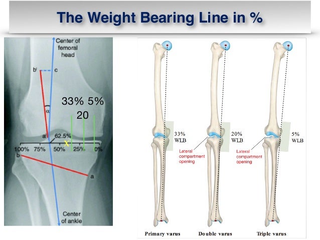 Osteoarthritis in the young