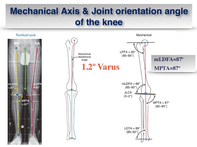 Osteoarthritis in the young
