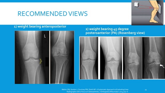 Osteoarthritis knee- introduction and approach | PPTX