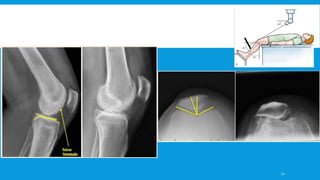 Osteoarthritis knee- introduction and approach | PPTX