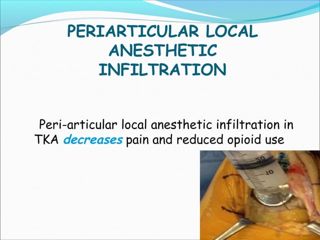 Clinical Evidence in the Surgical Treatment of Advanced Osteoarthritis ...