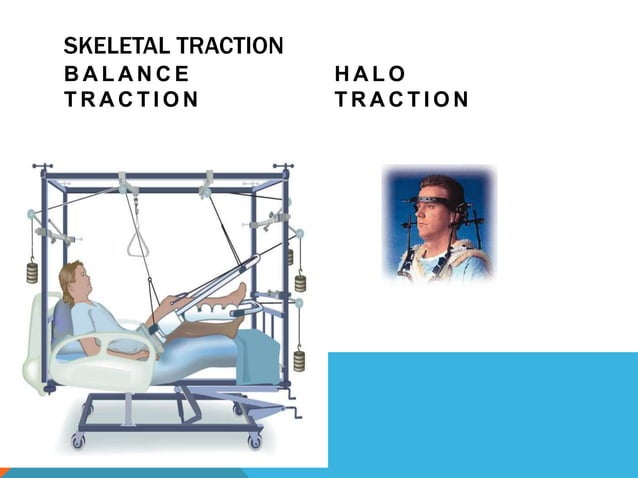 OA Mobility Fracture for Ethel.pptx