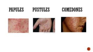 Occupational acne and dermatitis due to mineral oil | PPT