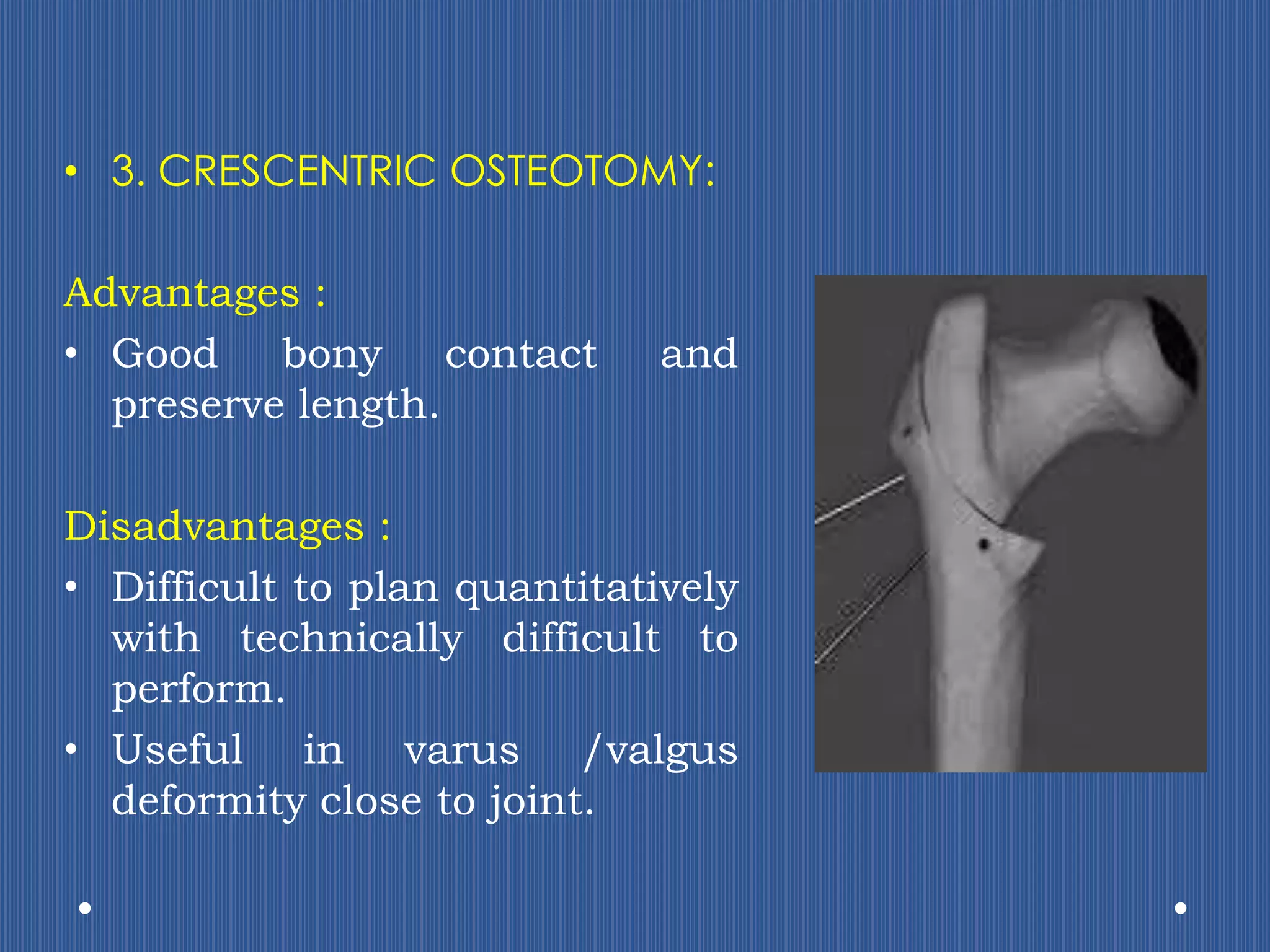 Osteotomies around hip by dr rohit kumar | PPTX
