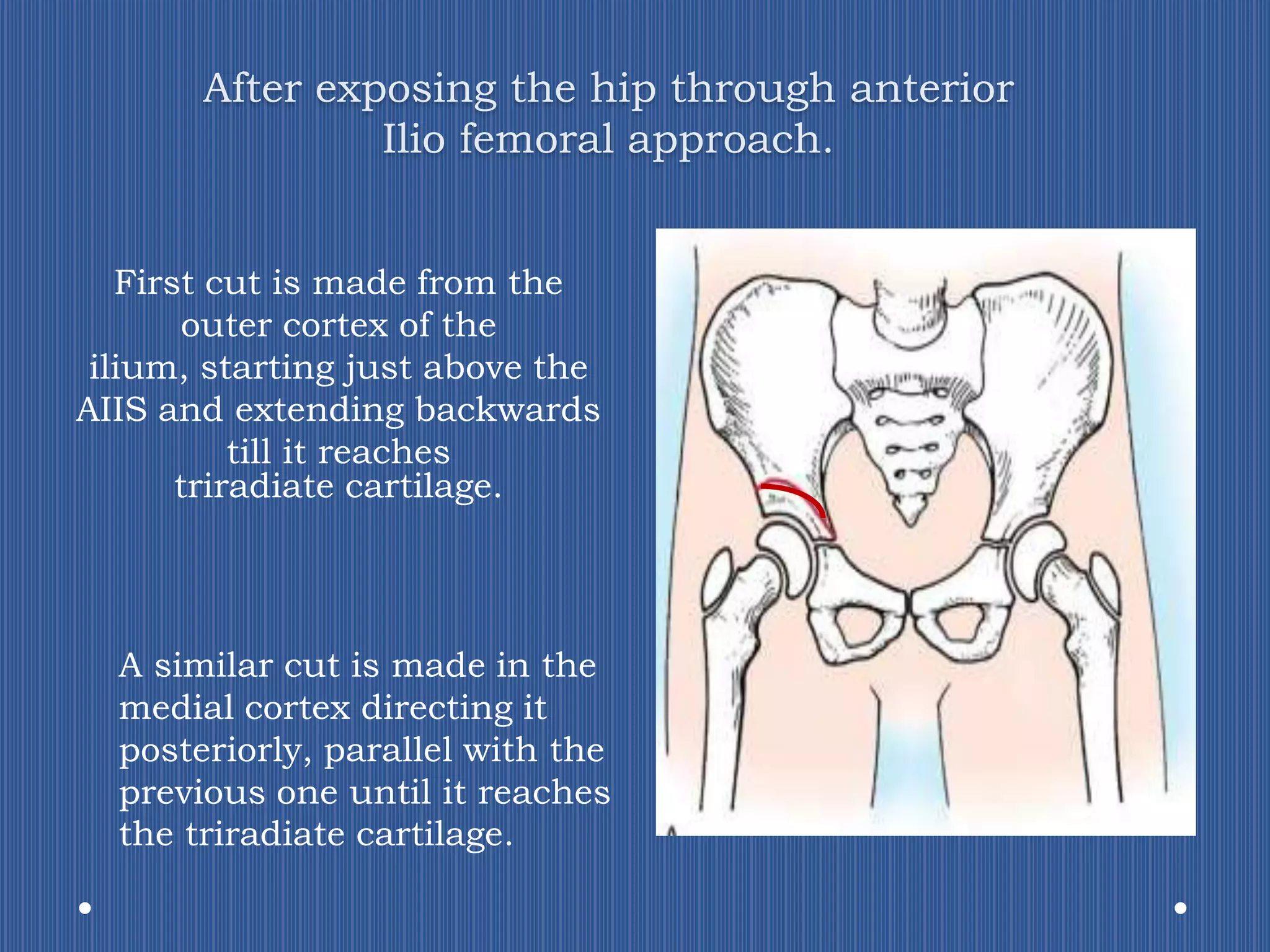 Osteotomies around hip by dr rohit kumar | PPTX
