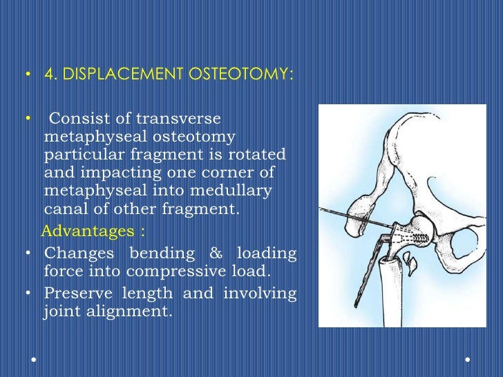 Osteotomies around hip by dr rohit kumar Osteotomies around hip by dr rohit kumar