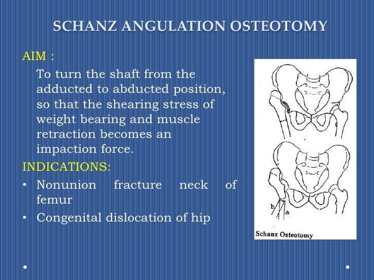 Osteotomies around hip by dr rohit kumar Osteotomies around hip by dr rohit kumar