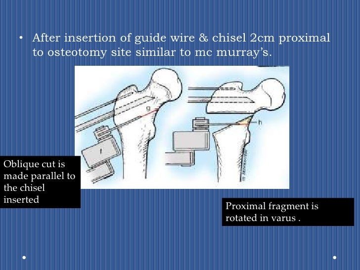 Osteotomies around hip by dr rohit kumar Osteotomies around hip by dr rohit kumar
