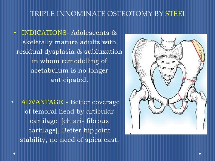 Osteotomies around hip by dr rohit kumar Osteotomies around hip by dr rohit kumar