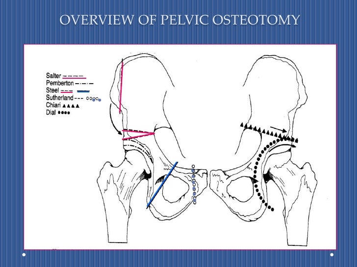 Osteotomies around hip by dr rohit kumar Osteotomies around hip by dr rohit kumar