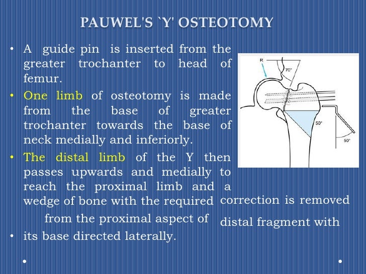 Osteotomies around hip by dr rohit kumar Osteotomies around hip by dr rohit kumar
