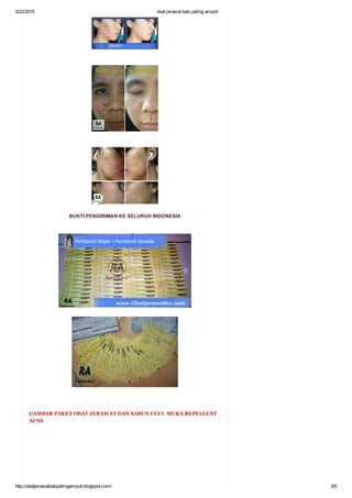Obat jerawat batu paling ampuh | PDF