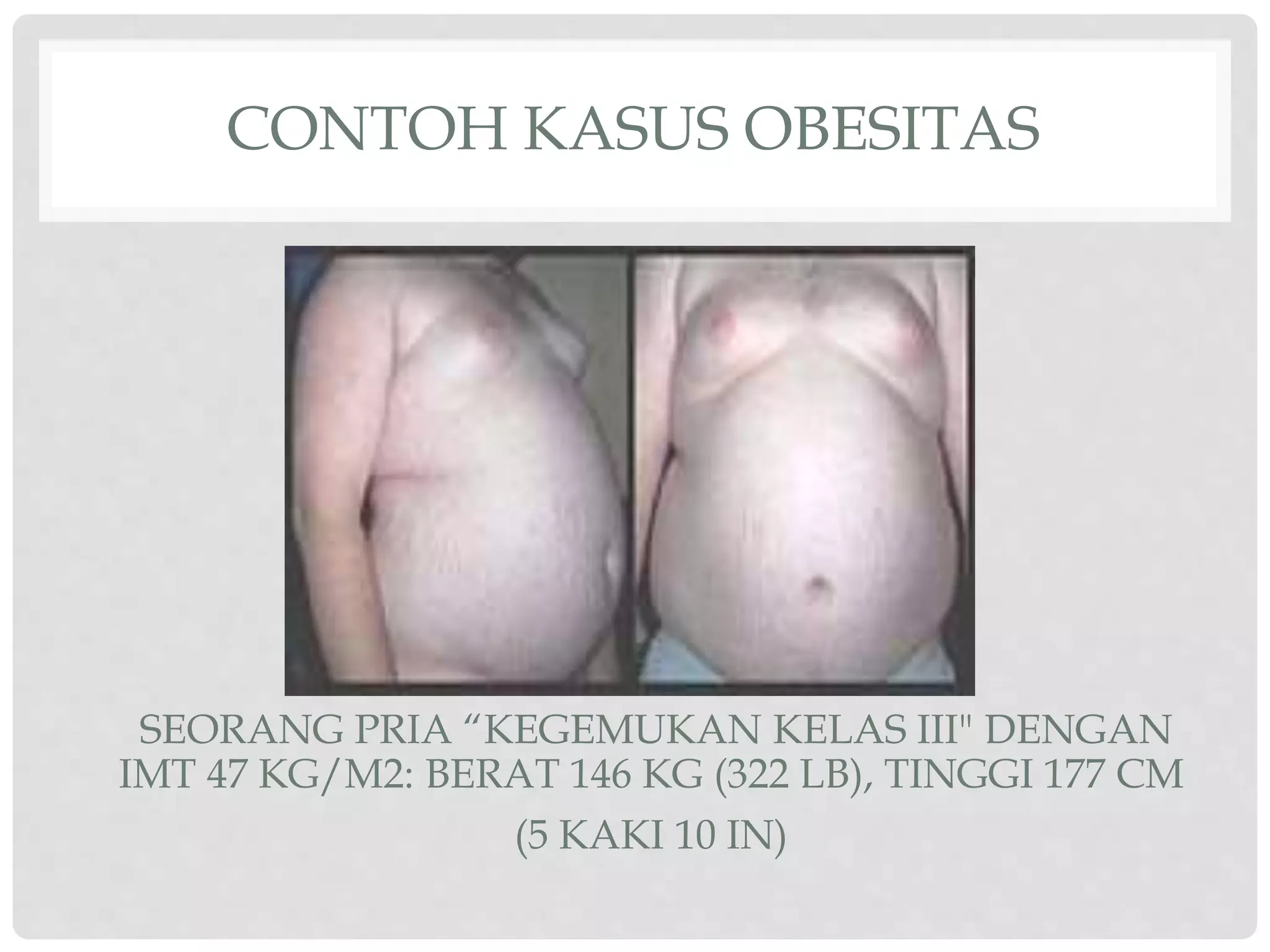 Obesitas.ppt