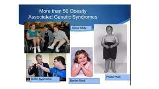 Obesity in children.pptx