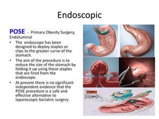 Obesity, the armamentarium | PPT