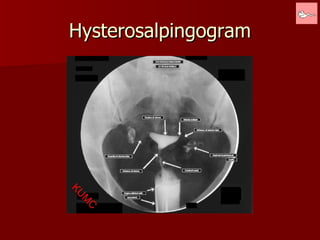 Obg01 Infertility | PPT