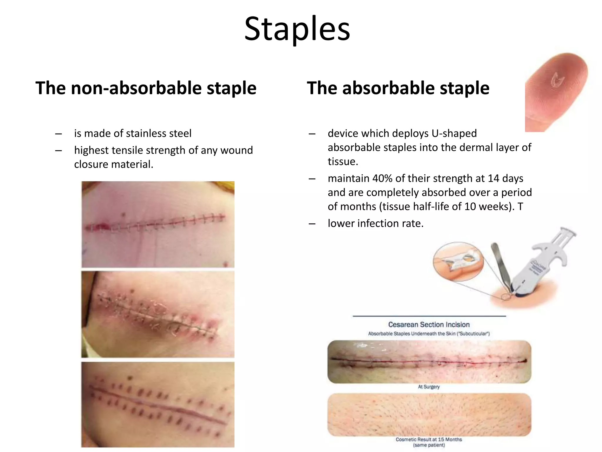 Abdominal Incisions and sutures | PPTX
