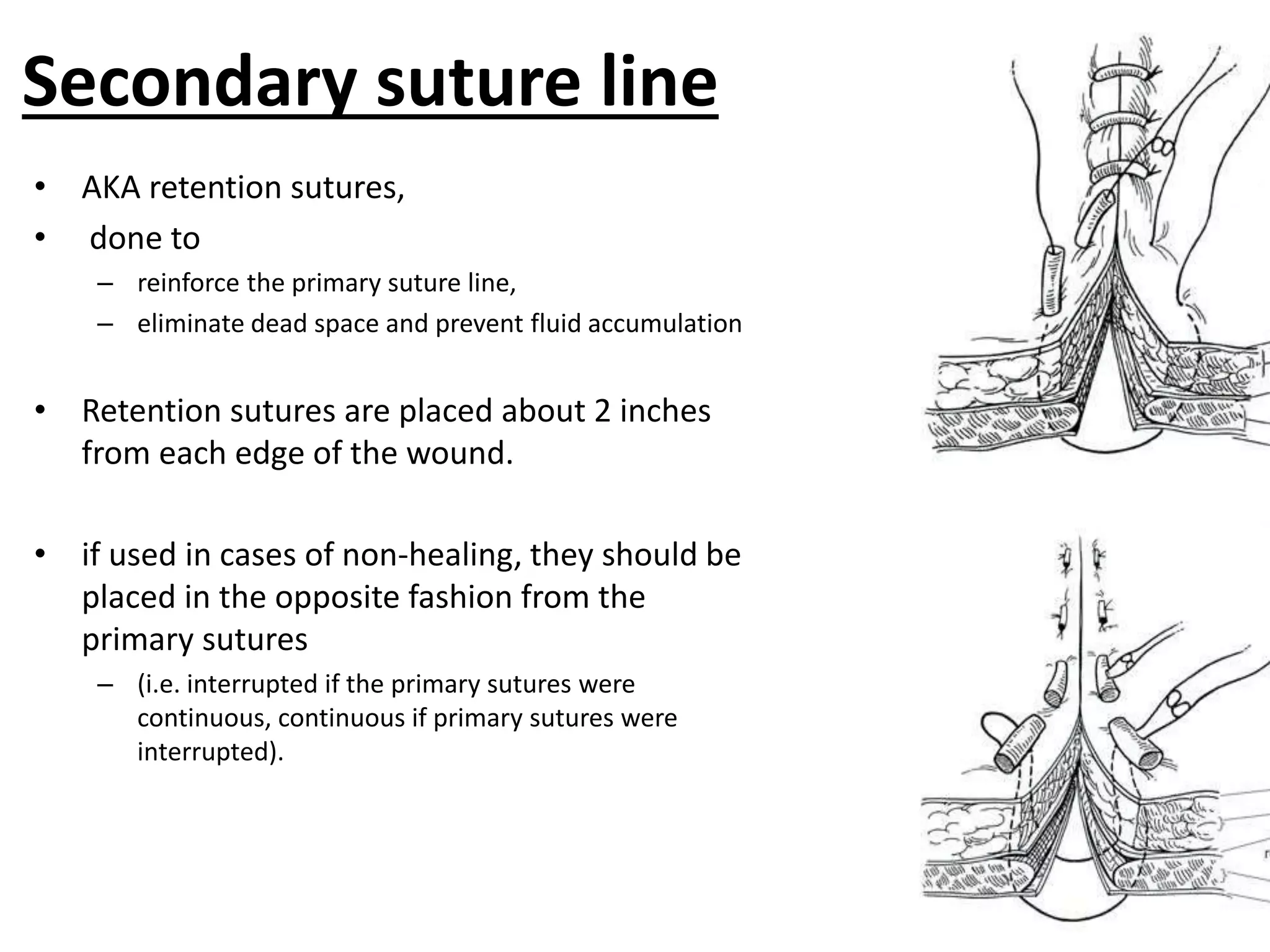 Abdominal Incisions and sutures | PPTX