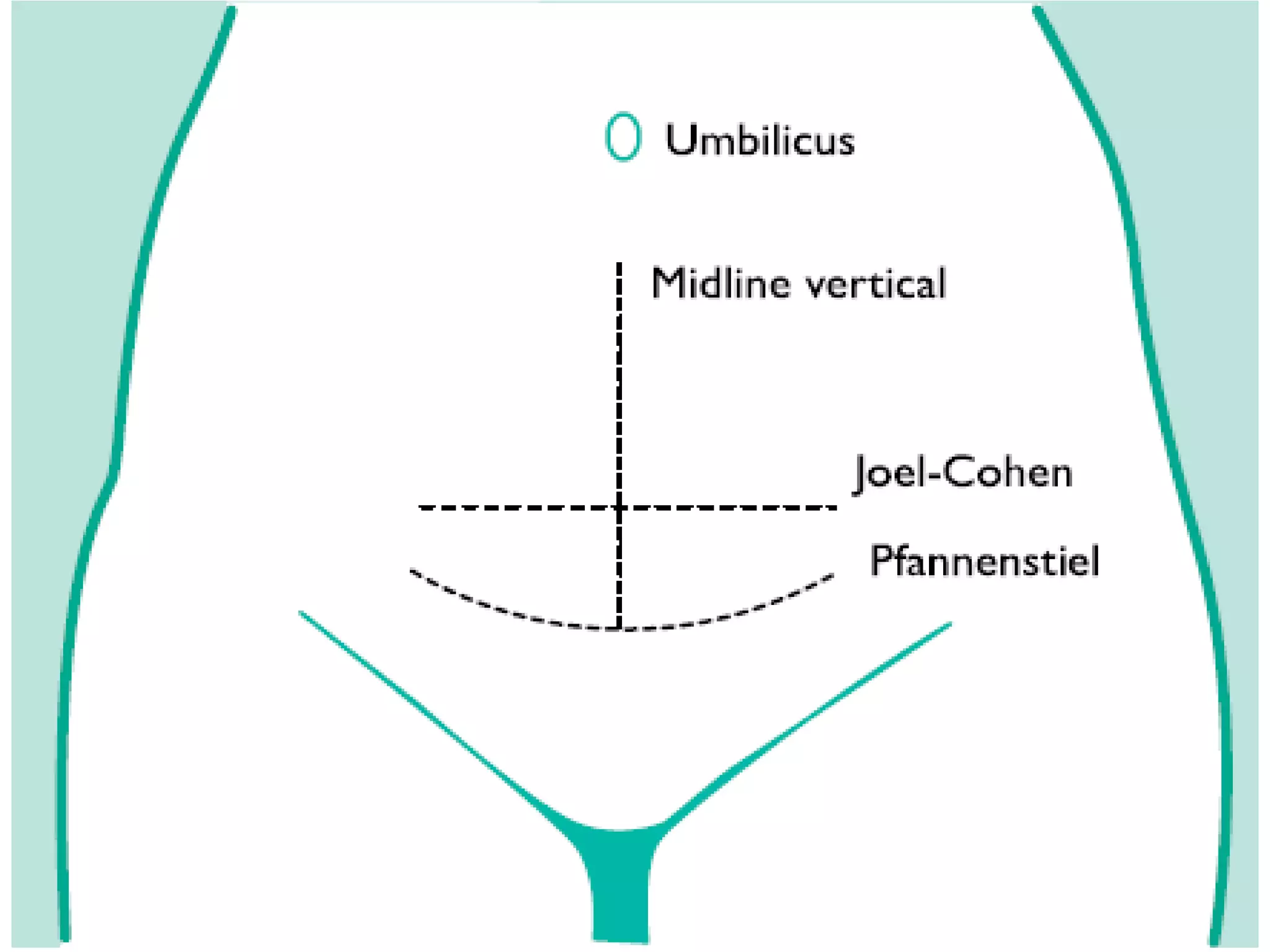 Abdominal Incisions and sutures | PPTX