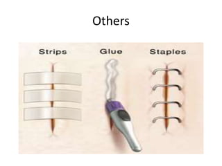 Abdominal Incisions and sutures | PPTX