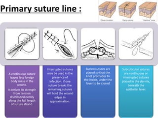 Abdominal Incisions and sutures | PPTX