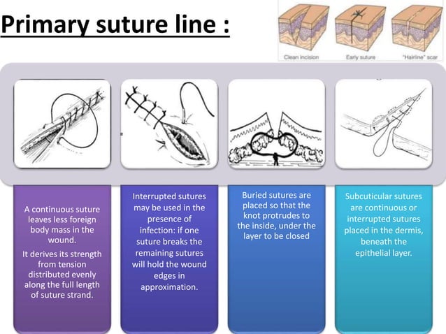 Abdominal Incisions and sutures | PPTX