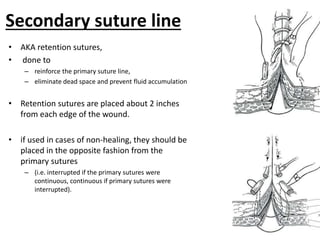 Abdominal Incisions and sutures | PPTX