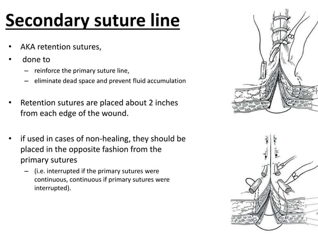 Abdominal Incisions and sutures | PPTX