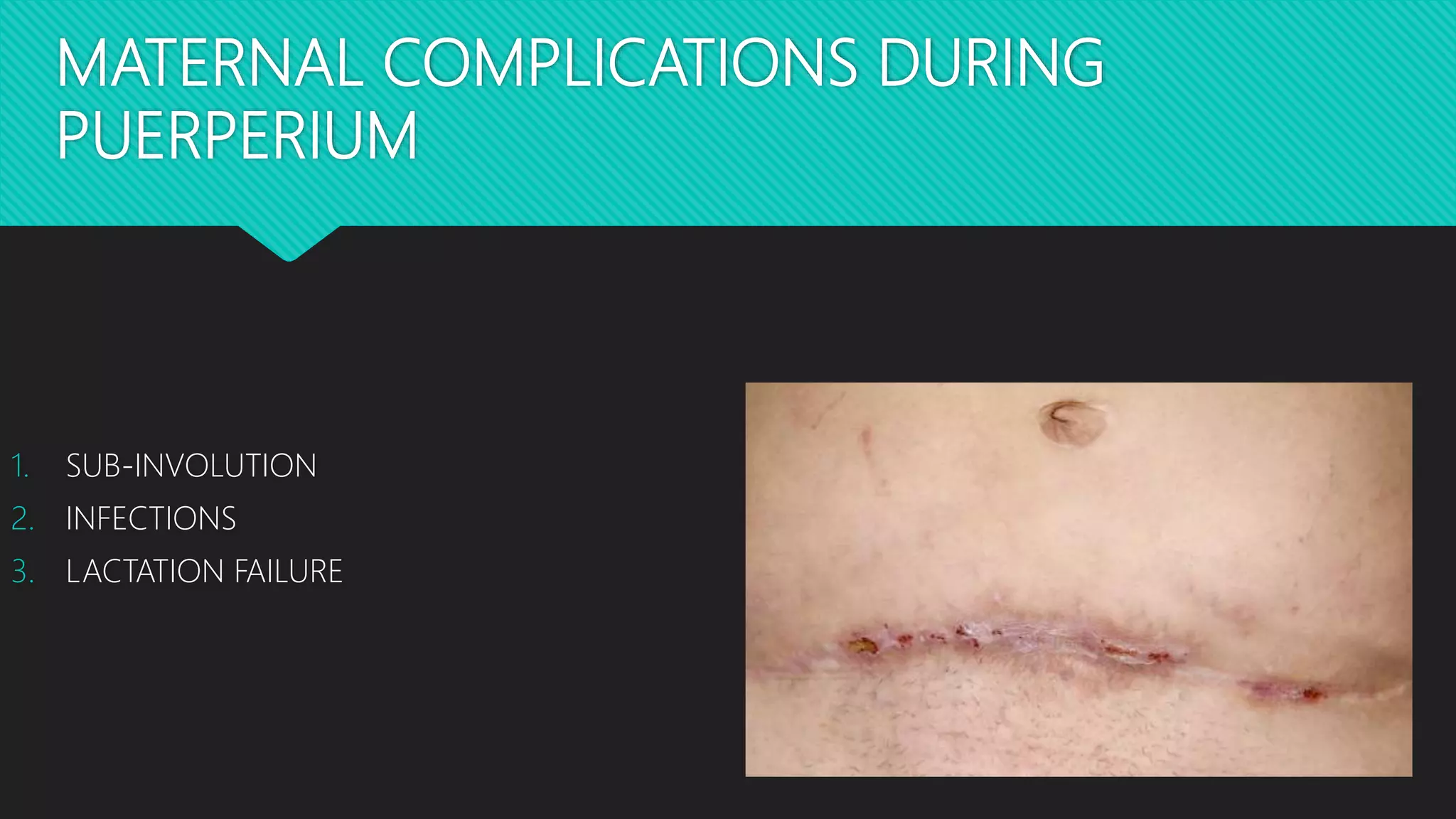 Complications of multiple pregnancy | PPTX