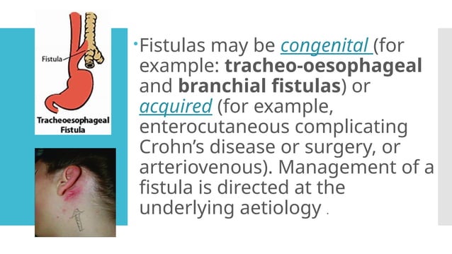 Comprehensive Overview of Genito-Urinary Fistula: Etiology ...