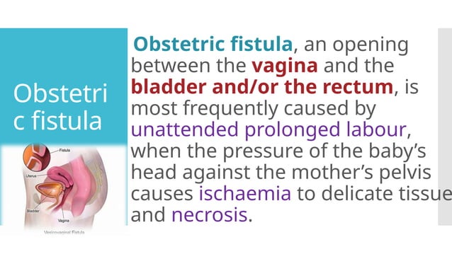 Comprehensive Overview of Genito-Urinary Fistula: Etiology ...