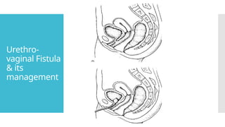 Comprehensive Overview of Genito-Urinary Fistula: Etiology ...