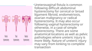 Comprehensive Overview of Genito-Urinary Fistula: Etiology ...