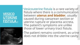 Comprehensive Overview of Genito-Urinary Fistula: Etiology ...